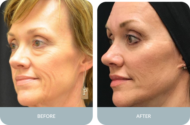 Fat Injections Tupelo | Facial Fat Grafting Mississippi | Accent ...